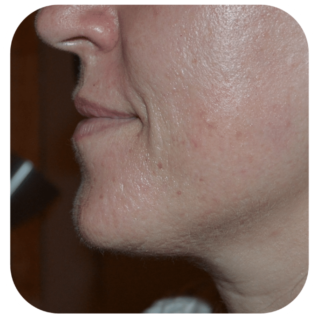 Cosmetic Acupuncture Before And After Photos | Qi Medicine