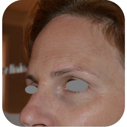 Cosmetic Acupuncture Before And After Photos | Qi Medicine